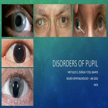 Trastornos de la pupila - Disorders of pupil | PPTX