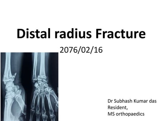 Clavicle fracture | PDF