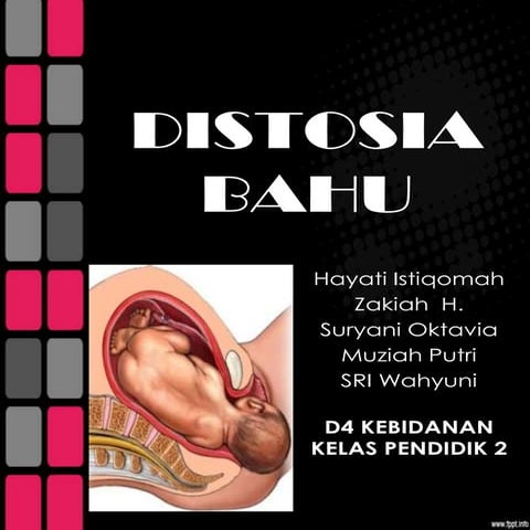 Distosia bahu | PPTX