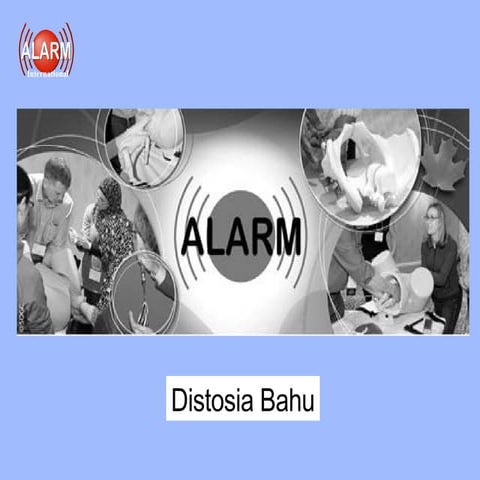 Distosia bahu ALARM.pptx Distosia bahu ALARM.pptx Distosia bahu ALARM.pptx