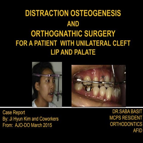 Distraction osteogenesis in CLP | PPTX