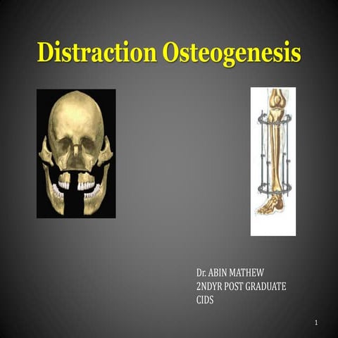 Distraction osteogenesis | PPTX