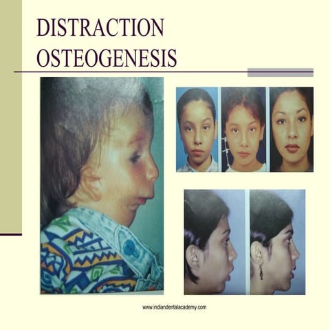 Distraction osteogenesis (8) | PPT