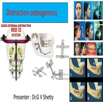 Distraction osteogenesis in orthodontics -Dr.G V SHETTY | PPTX