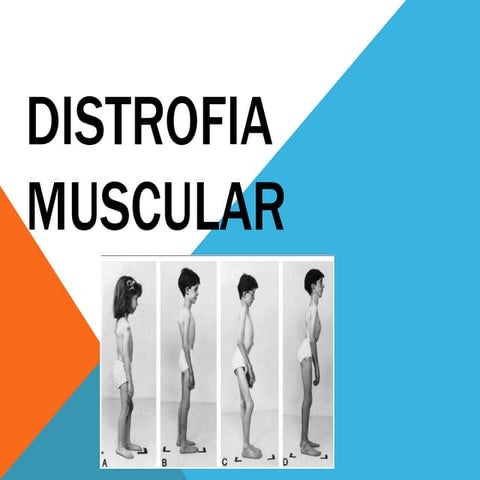 Distrofia muscular | PPTX