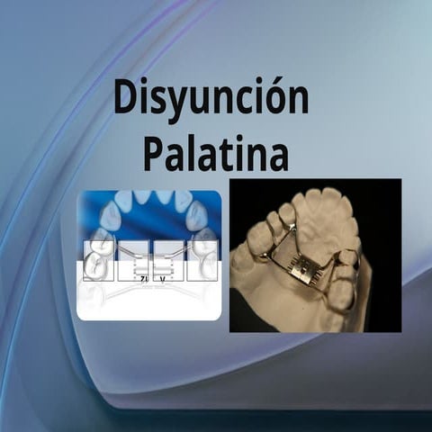 Disyuncion Rápida palatina del maxilar superior | PPTX