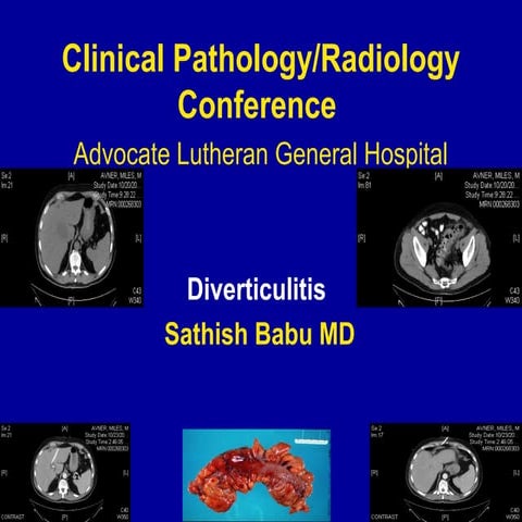 Diagnosis and treatment of Diverticulitis | PPTX
