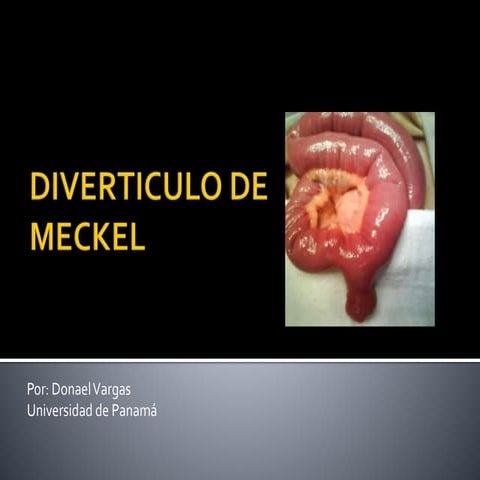 Diverticulo de meckel | PPTX