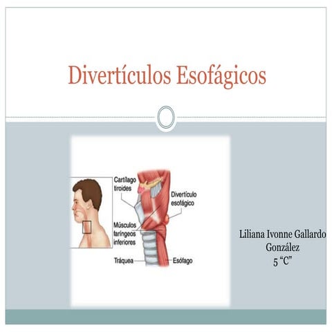 Diverticulos esofagicos | PPTX
