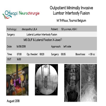 Outpatient Minimally Invasive Lumbar Interbody Fusion DLIF X Jaws | PDF