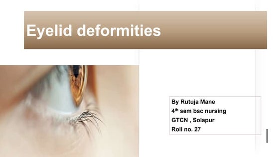 Chalazion | PPT