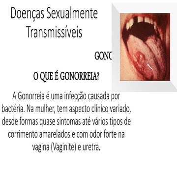 Doenças sexualmente transmissíveis nathalia[ | PDF
