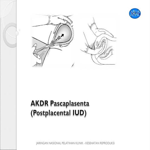 dokumen.tips_akdr-pascaplasenta pasca persalinan.ppt