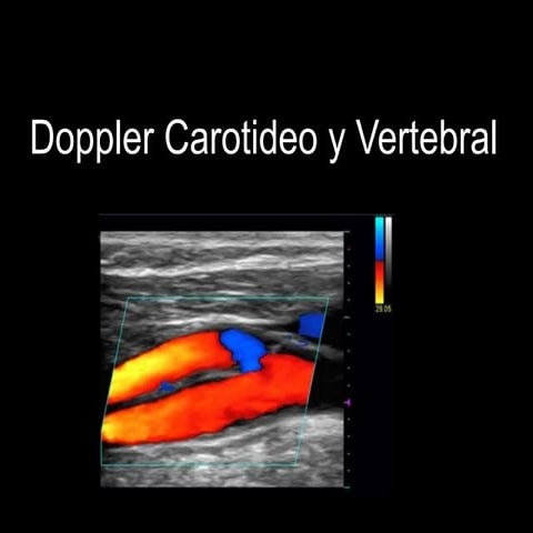 DOPPLER DE ARTERIAS CAROTIDAS VERTEBRALES.pptx