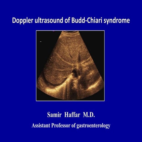 Doppler ultrasound of Budd Chiari syndrome & SOS | PPTX