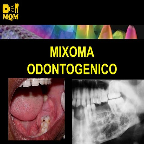 MIXOMA ODONTOGENICO | PPT