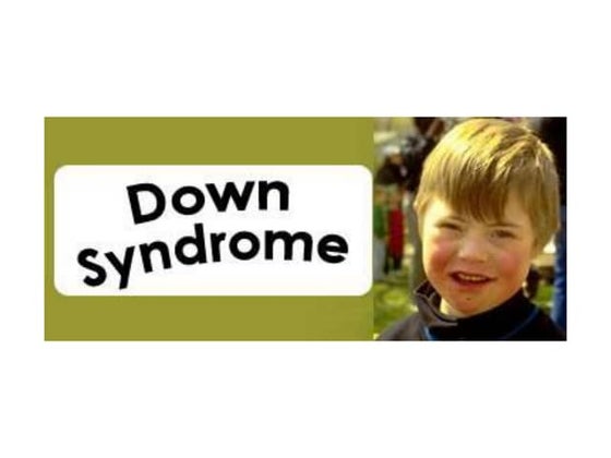 Down syndrome Characteristics, Diagnosis, Prognosis, Treatment | PPT