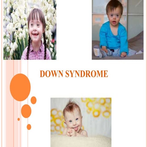Down syndrome | PPT