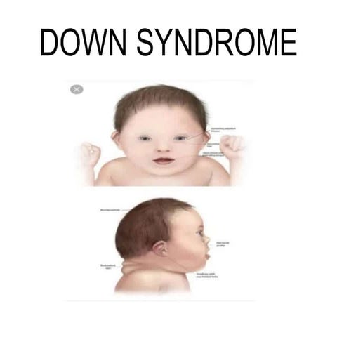 DOWN SYNDROME.pptx