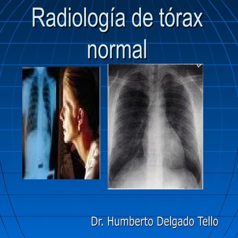 Rx de torax normal