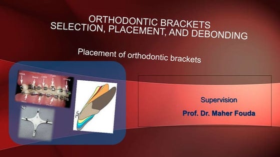 mbt bracket placement | PPT
