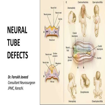 Neural Tube Defects for Undergraduate Medical Students | PPT