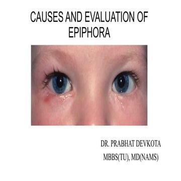 CAUSES AND EVALUATION OF EPIPHORA-DR.PRABHAT DEVKOTA.pptx