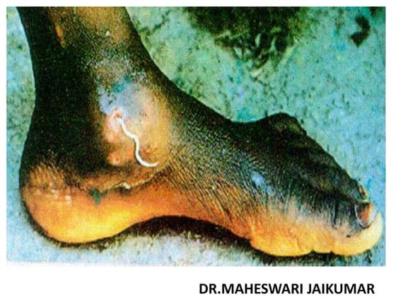 National guinea worm eradication programme in India | PPTX | Infectious ...