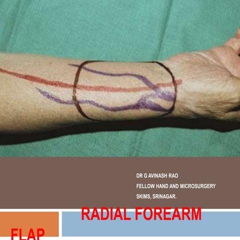 Radial Forearm Flap | PPTX