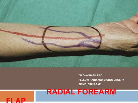 V-Y Advancement flap - for Fingertip amputations | PPTX | Death, Injury ...