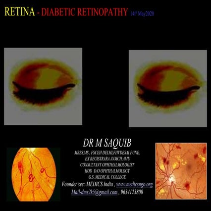 Diabetic Retinopathy- PDR and CSME | PPTX