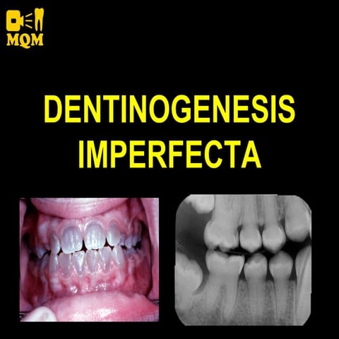 Dentinogénesis Imperfecta | PDF