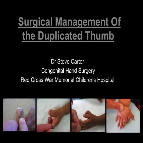 Duplicated thumb | PPT