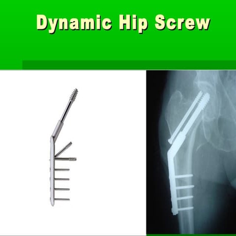 Dynamic hip screw | PPT