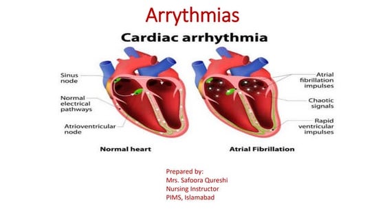Arrhythmias | PDF | Heart and Cardiovascular Diseases | Diseases and Conditions
