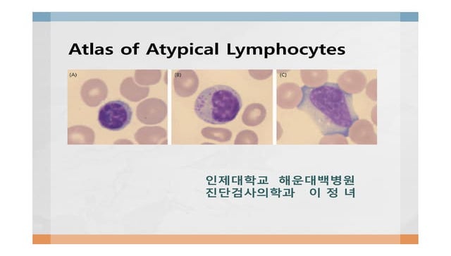 Atypical Lymphocyte Ebv