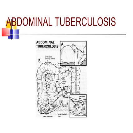 Small Intestine TB (Tuberculosis) | PPTX