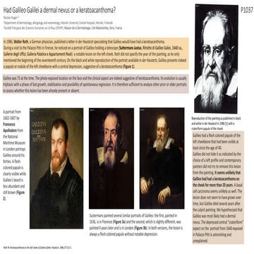 Had Galileo a keratoacanthoma? EADV 2019, Poster 1037 | PPTX