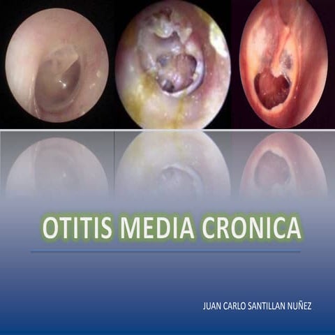 Otitis media crónica
