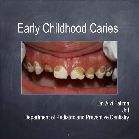 ANGLE'S CLASSIFICATION OF MALOCCLUSION | PPTX