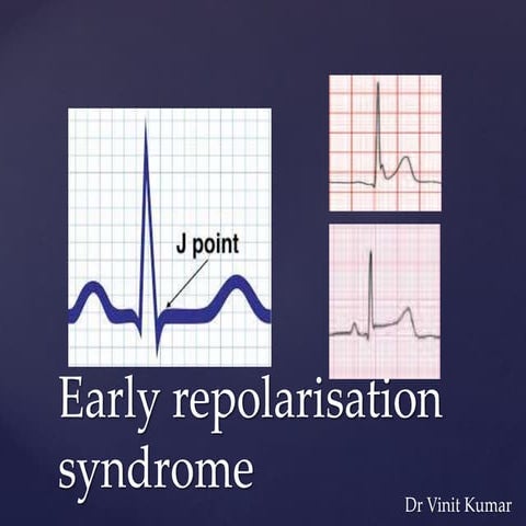 Early repolarisation syndrome (2) | PPTX