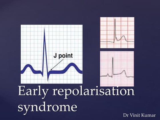 Repolarization syndromes | PPT