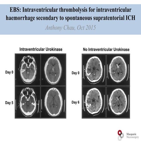 Ebs tpa for ivh ich | PPT