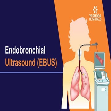 Endobronchial Ultrasound Bronchoscopy (EBUS) | PPT