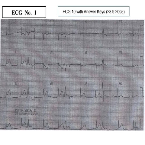 ECG 10 with Answer Keys (23.9.2005).ppt