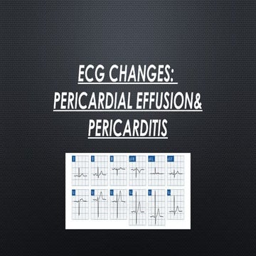 ecg changes in pericarditis and pleural effusion - Priyanshi Rastogi ...
