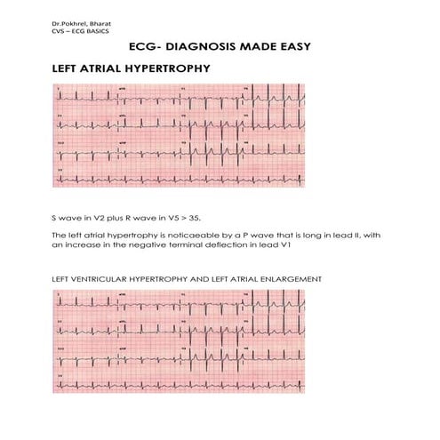 Ecg made easy by pokhrel, bharat | PDF