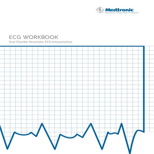 ECG tracing in pacemaker patients | PDF