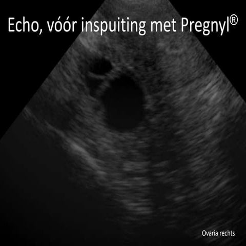 Echo, voor inspuiting met pregnyl | PPTX