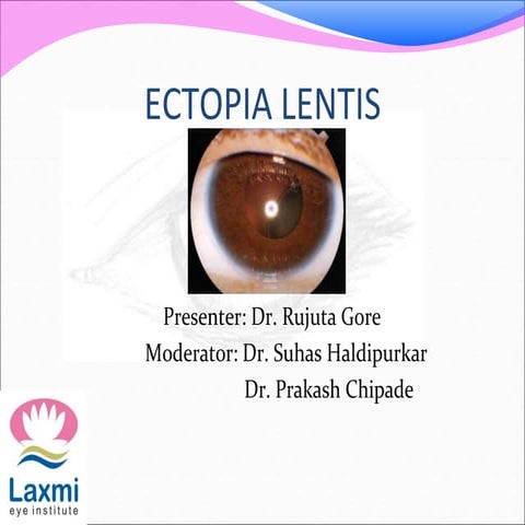 Ectopia lentis | PPTX